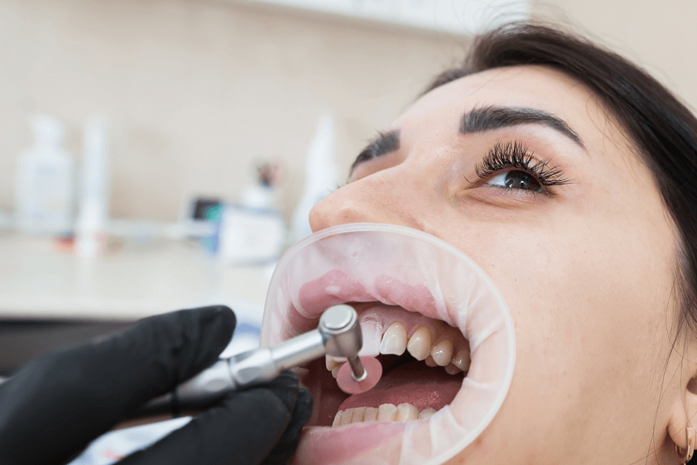 How to Choose Between Veneers and Bonding | Perfect Smile Spa