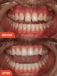 Composite Bonding vs Veneers: Which Smile Upgrade Is Right for You ...